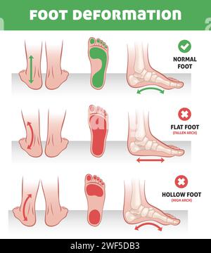 Foot deformation poster. Medical scheme with leg curvature types. Flat ...