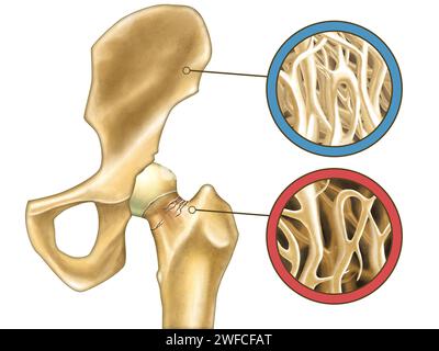 Femur bone human, close up of upper part to show the neck of femur, the ...