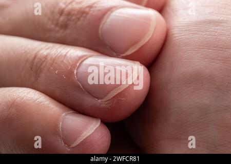 Macro photo of vertical ridges in fingernails Stock Photo - Alamy