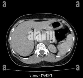Aortic aneurysm. Computed tomography (CT) scan of an axial section ...