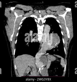 Enlarged aorta. Computed tomography (CT) scan of a side view of a human ...