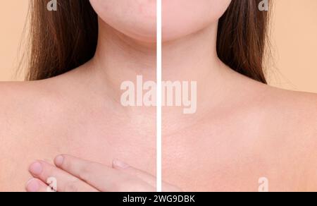 Aging skin changes. Woman showing neck before and after rejuvenation ...