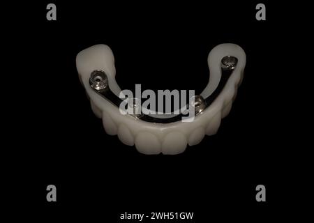 Hybrid Prosthesis: Dental Implants with Metal Bar and 3D-Printed ...