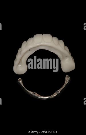 Hybrid Prosthesis: Dental Implants with Metal Bar and 3D-Printed ...