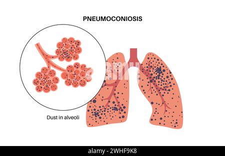 Pneumoconiosis lung disease, illustration Stock Photo - Alamy