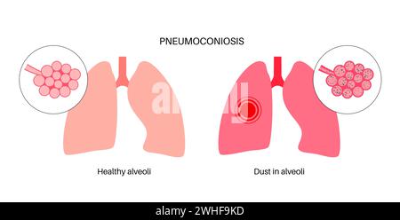 Pneumoconiosis lung disease, illustration Stock Photo - Alamy