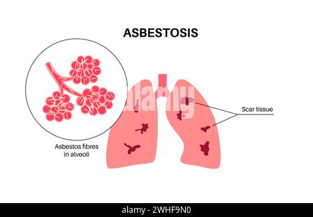 Asbestosis lung disease, illustration Stock Photo - Alamy