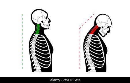 Neck vertebrae deformity, illustration Stock Photo - Alamy