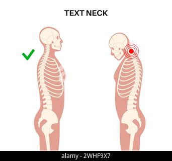 Neck vertebrae deformity, illustration Stock Photo - Alamy