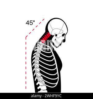 Neck vertebrae deformity, illustration Stock Photo - Alamy