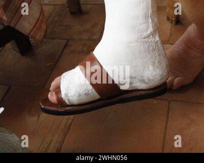 injured foot in a cast after an accident, injured part of the body ...