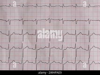 EKG heart beat, electrocardiogram results Stock Photo - Alamy
