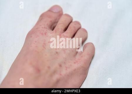 Allergic reaction, Red rash itychy on foot caused by weather or fungi ...