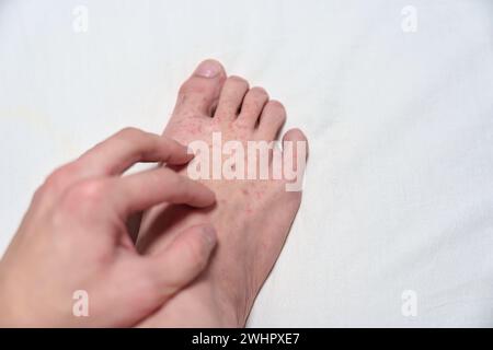 Allergic reaction, Red rash itychy on foot caused by weather or fungi ...