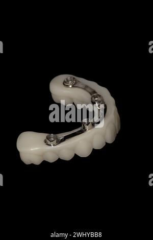 Hybrid Prosthesis: Dental Implants with Metal Bar and 3D-Printed ...