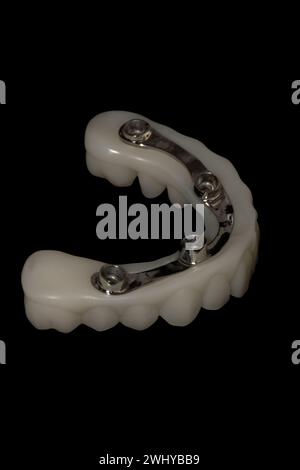 Hybrid Prosthesis: Dental Implants with Metal Bar and 3D-Printed ...