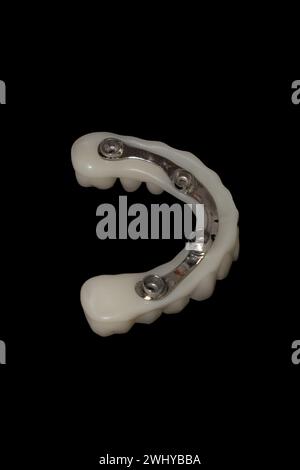 Hybrid Prosthesis: Dental Implants with Metal Bar and 3D-Printed ...