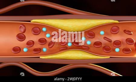 3d rendering of plaque formation of Cholesterol in artery ...