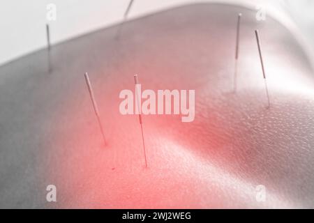 Close-up of female body with steel needles inserted during procedure of ...