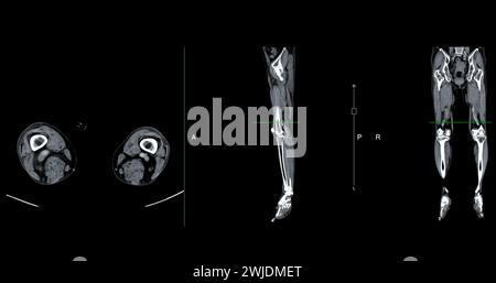 A CT venogram of the leg is a non-invasive imaging procedure offering ...