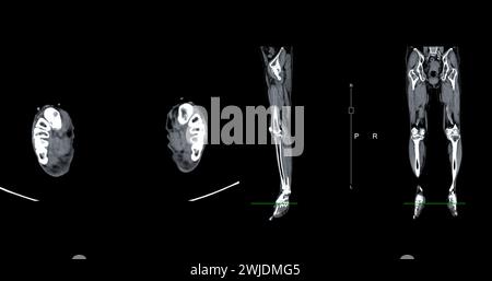 A CT venogram of the leg is a non-invasive imaging procedure offering ...