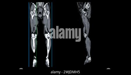 A CT venogram of the leg is a non-invasive imaging procedure offering ...