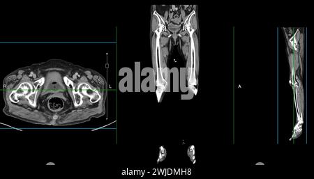 A CT venogram of the leg is a non-invasive imaging procedure offering ...