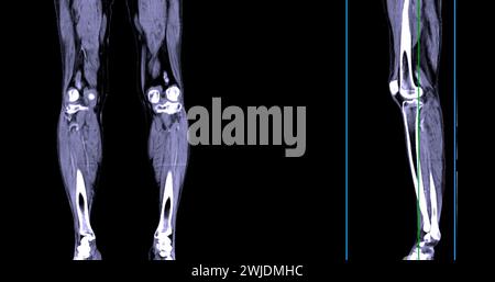 A CT venogram of the leg is a non-invasive imaging procedure offering ...