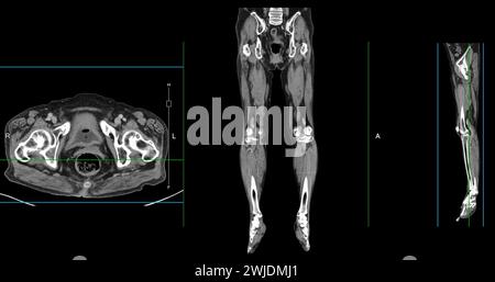 A CT venogram of the leg is a non-invasive imaging procedure offering ...