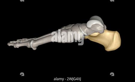 The calcaneus (heel bone) is the largest of the tarsal bones in the ...
