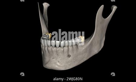 The mandibular third molar is also referred as the wisdom tooth 3d ...