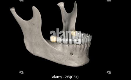 The mandibular third molar is also referred as the wisdom tooth 3d ...