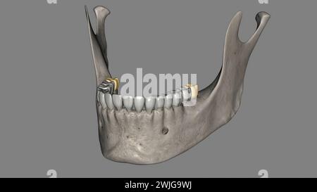 The mandibular third molar is also referred as the wisdom tooth 3d ...