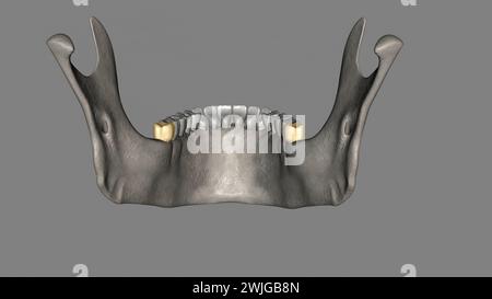 The mandibular third molar is also referred as the wisdom tooth 3d ...