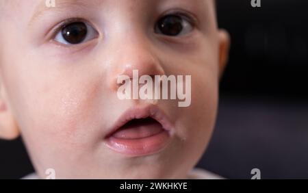 Bacterial diseases in the nose. Yellow snot from the nose of a little ...