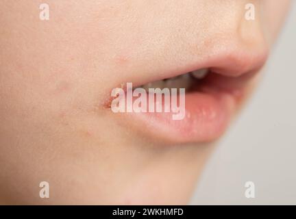 Pain and itching in the corners of the lips of a girl's mouth. Seizures ...