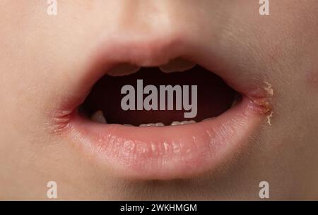 slit-like impetigo in a little girl in the corners of her mouth. Skin ...