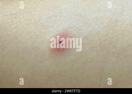 Allergy, dermatitis, virus or bacterial infection on human skin ...