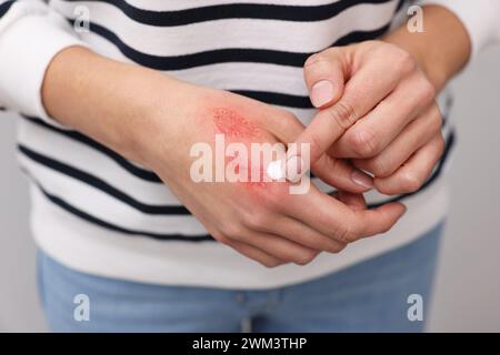 Woman applying healing cream onto burned hand on brown background ...