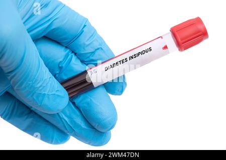 Diabetes Insipidus Test with blood sample in green gloved hands ...