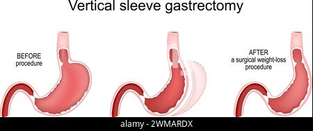 Vertical sleeve gastrectomy. Stomach reduction. Surgical procedure ...