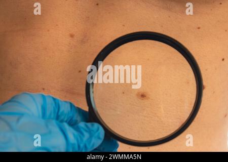 Mole dermoscopy, preventive of melanoma. Dermatologist examining ...