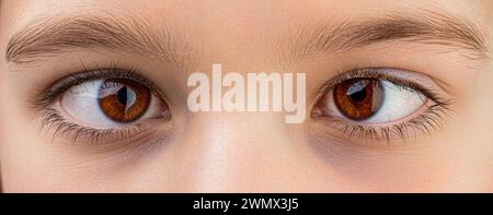 Strabismus in children causes, treatment concept. Female eyes with ...