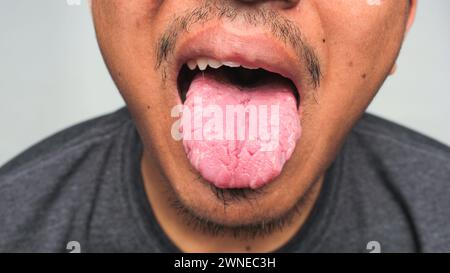 Inflammatory disease in the tongue. Red spot, glossitis. Hygiene of the ...