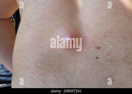 skin problems. problem of inflamed acne on the face. Inflamed acne ...