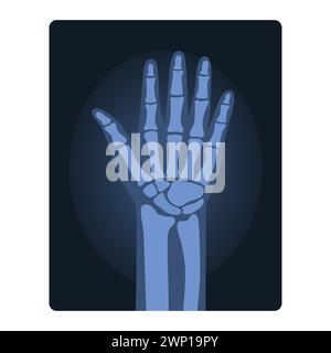 Xray shot of human hand. Medical injury test, body radiography cartoon ...