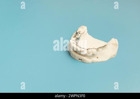 Metal Frame Lower Partial Denture with Die Stone, Plaster Cast Molds Of ...