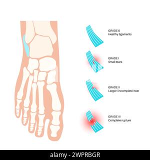 Ankle sprain injury, illustration. Twisted feet, pain and swelling ...