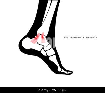 Ankle sprain injury, illustration. Twisted feet, pain and swelling ...