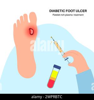 Diabetic foot syndrome treatment, illustration Stock Photo - Alamy